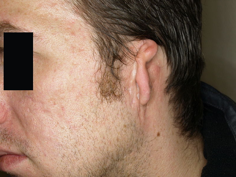 3D Printed Cartilage Ushers In Ear-a Of Custom Body Parts | Hackaday